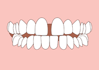 Empower Braces | Self-Ligating Braces in Claremont | Bayview Orthodontics